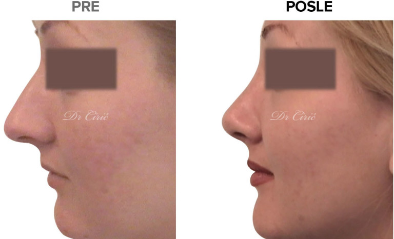 Operacija nosa | Korekcija nosa | Beograd | Laser | Hirurška i Nehirurška