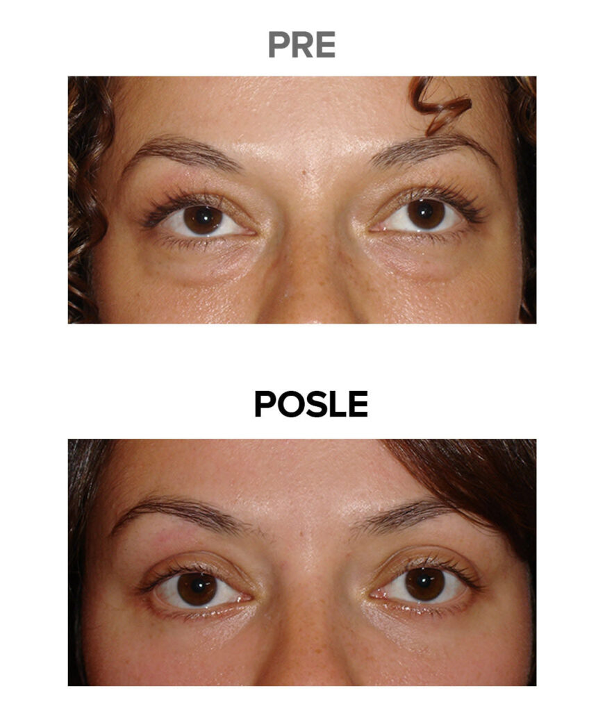 Slike Pre / Posle | Operacija kapaka | Korekcija kapaka | Klinika Dr Ćirić
