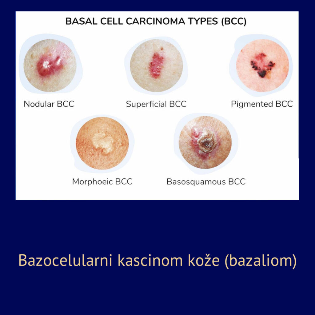 Bazocelularni kascinom kože (bazaliom) - Estetska plastična hirurgija ...