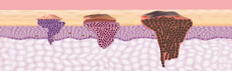 Bazocelularni kascinom kože (bazaliom) - Estetska plastična hirurgija ...
