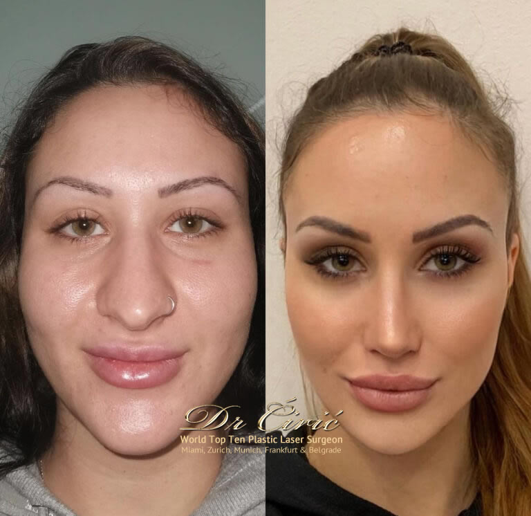 Operacija nosa | Korekcija nosa | Beograd | Laser | Hirurška i Nehirurška