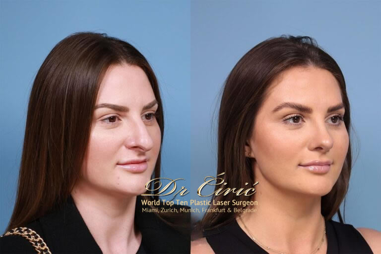 Ultrazvučna rinoplastika - Ultrazvučna operacija nosa - Estetska ...